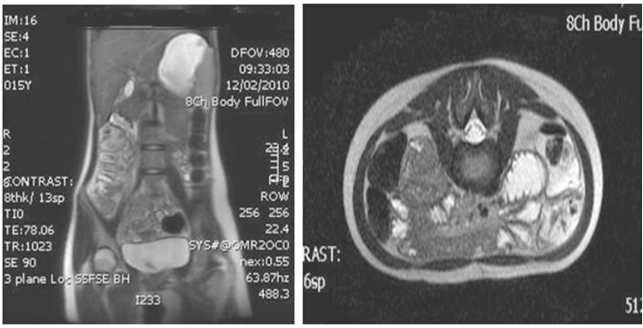 MR Pediatric Enterography WWO Protocol | OHSU